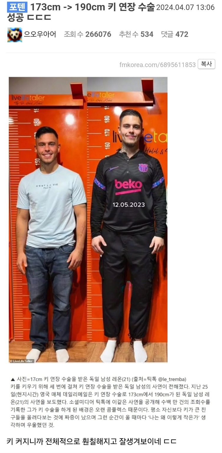 173cm -> 190cm 키 연장 수술 성공 ㄷㄷㄷ